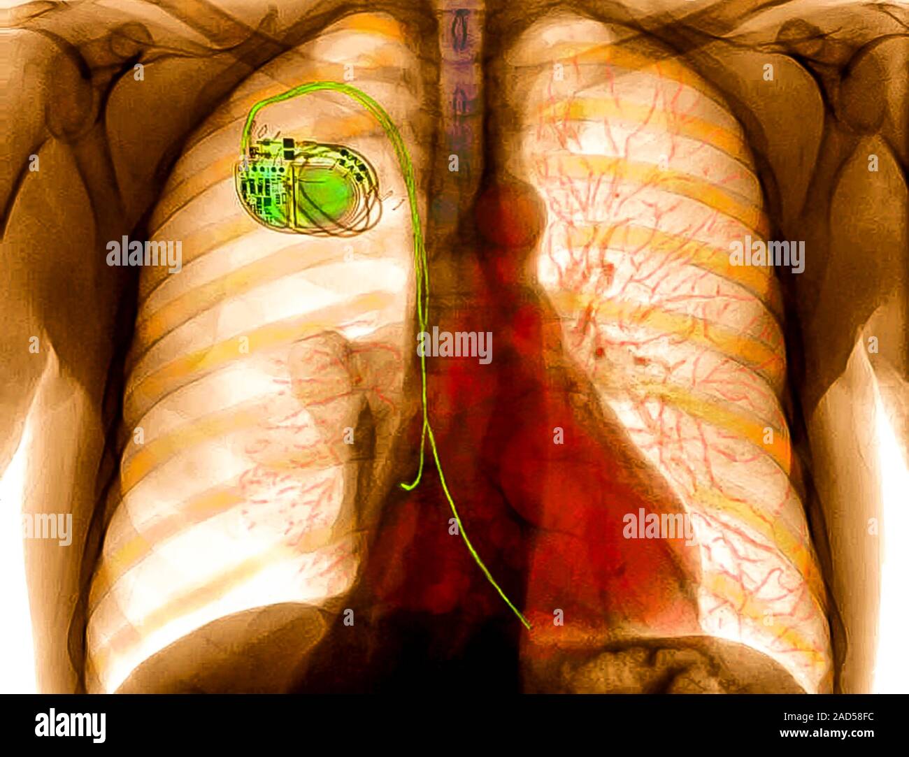 Cardiac pacemaker and pneumothorax. Coloured chest X-ray showing an ...
