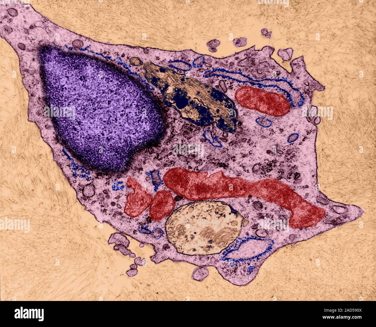 Neuroglia (microglia) cell destroying beta amyloid deposits by ...