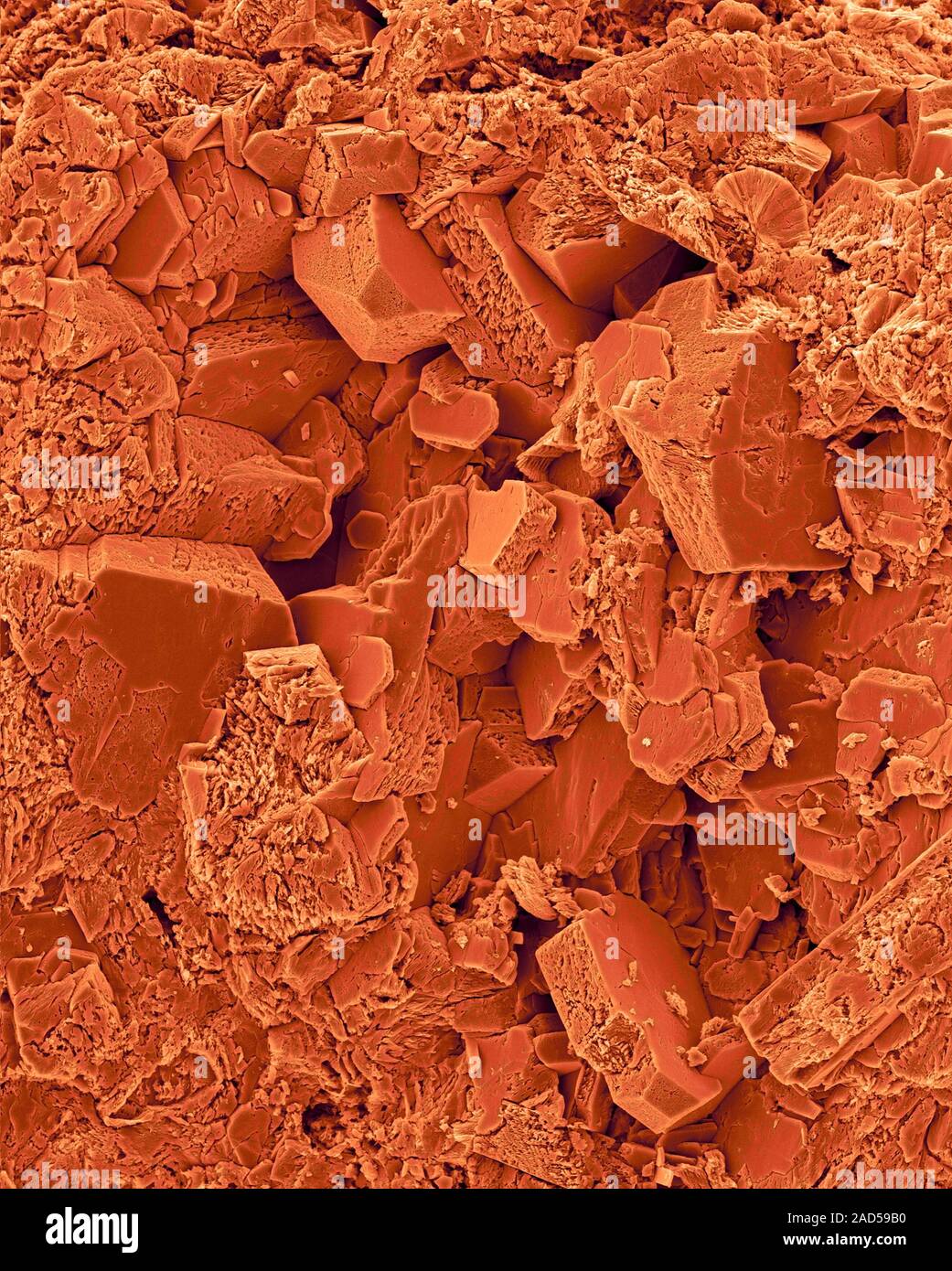 Kidney stone, coloured scanning electron micrograph (SEM). Kidney ...