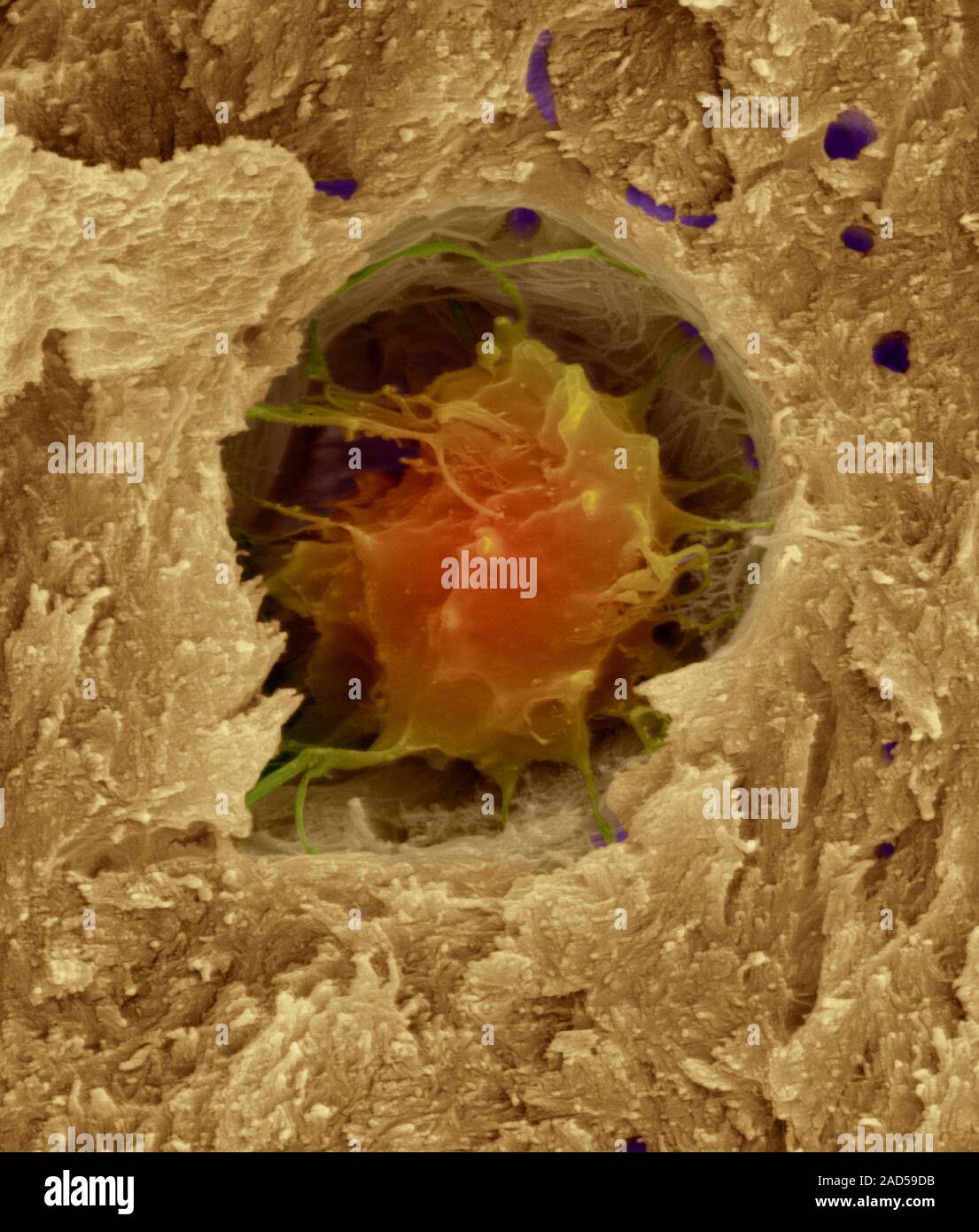Bone cell (osteocyte, orange-yellow) in a bone lacuna (light brown ...