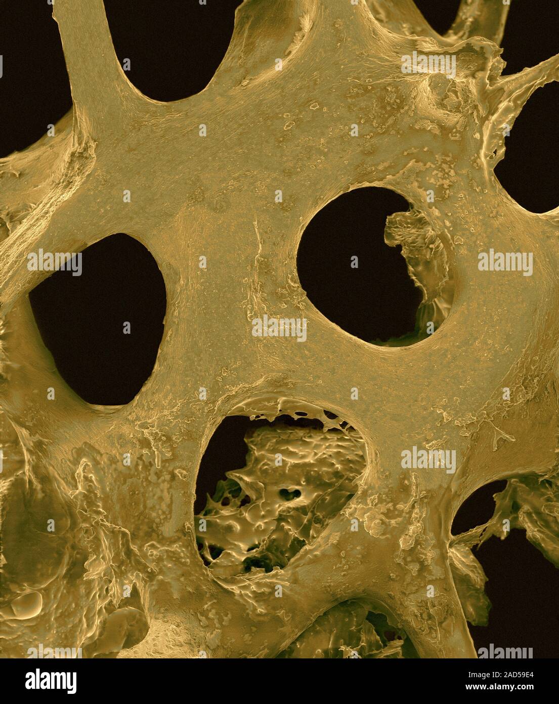 Cancellous (spongy) bone tissue, coloured scanning electron micrograph ...