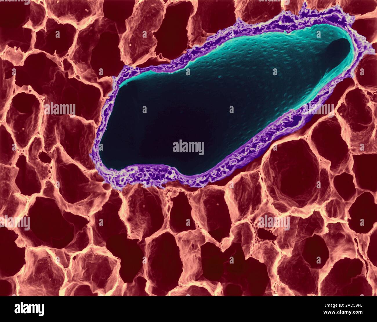 Human lung airways (large respiratory bronchiole and alveoli), coloured ...