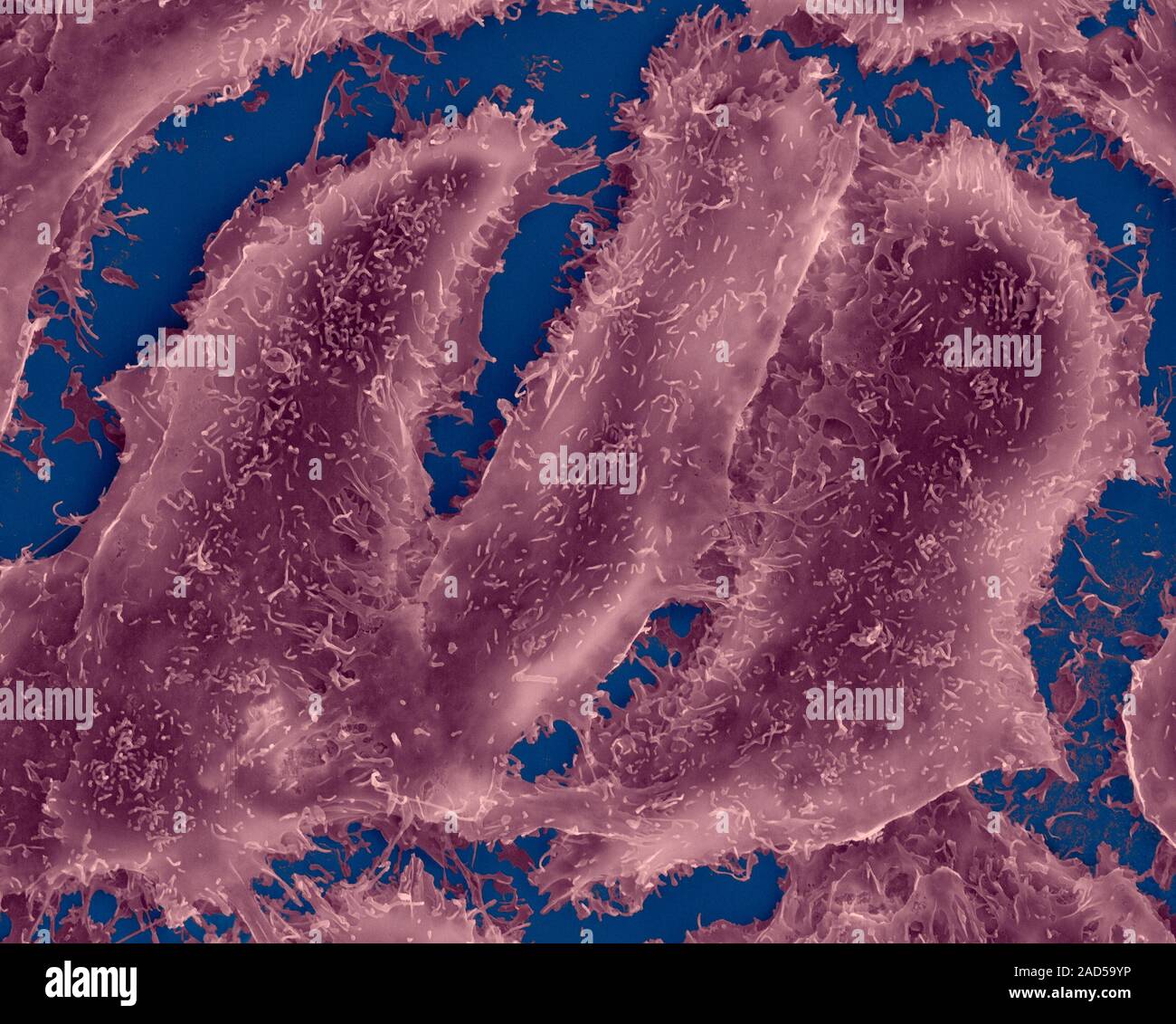 Human lung epithelial cancer cells (pulmonary mucoepidermal carcinoma ...