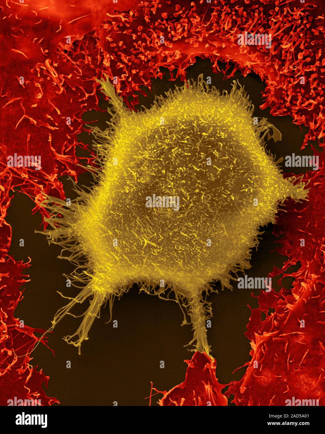 Human lung epithelial cancer cell among healthy epithelial cells ...