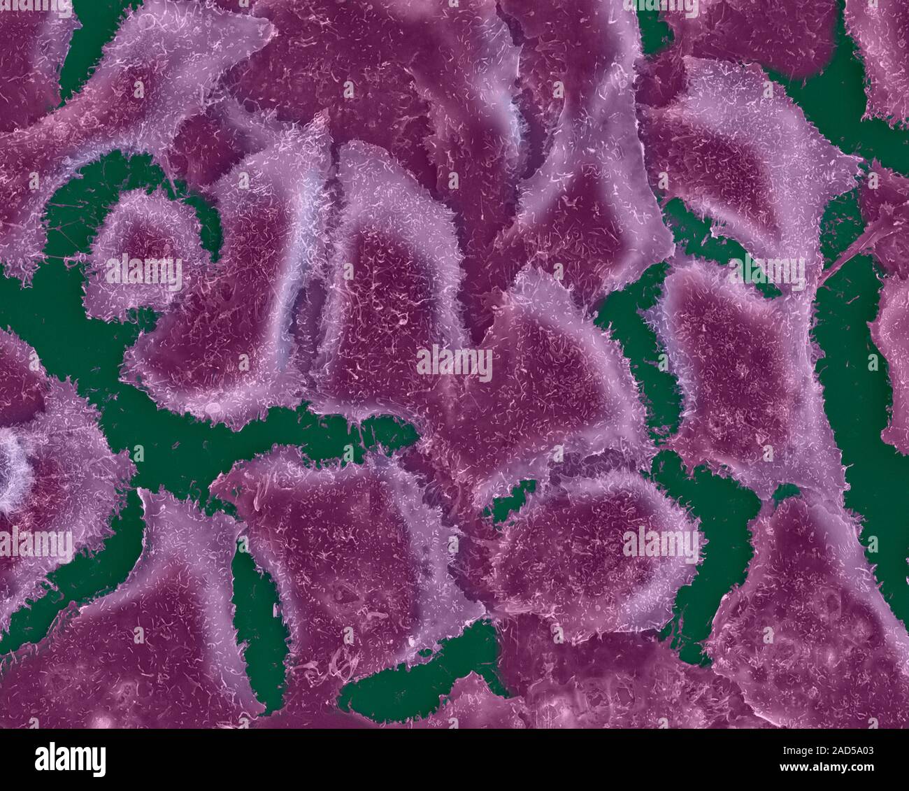 Human lung epithelial cancer cells (pulmonary mucoepidermal carcinoma ...