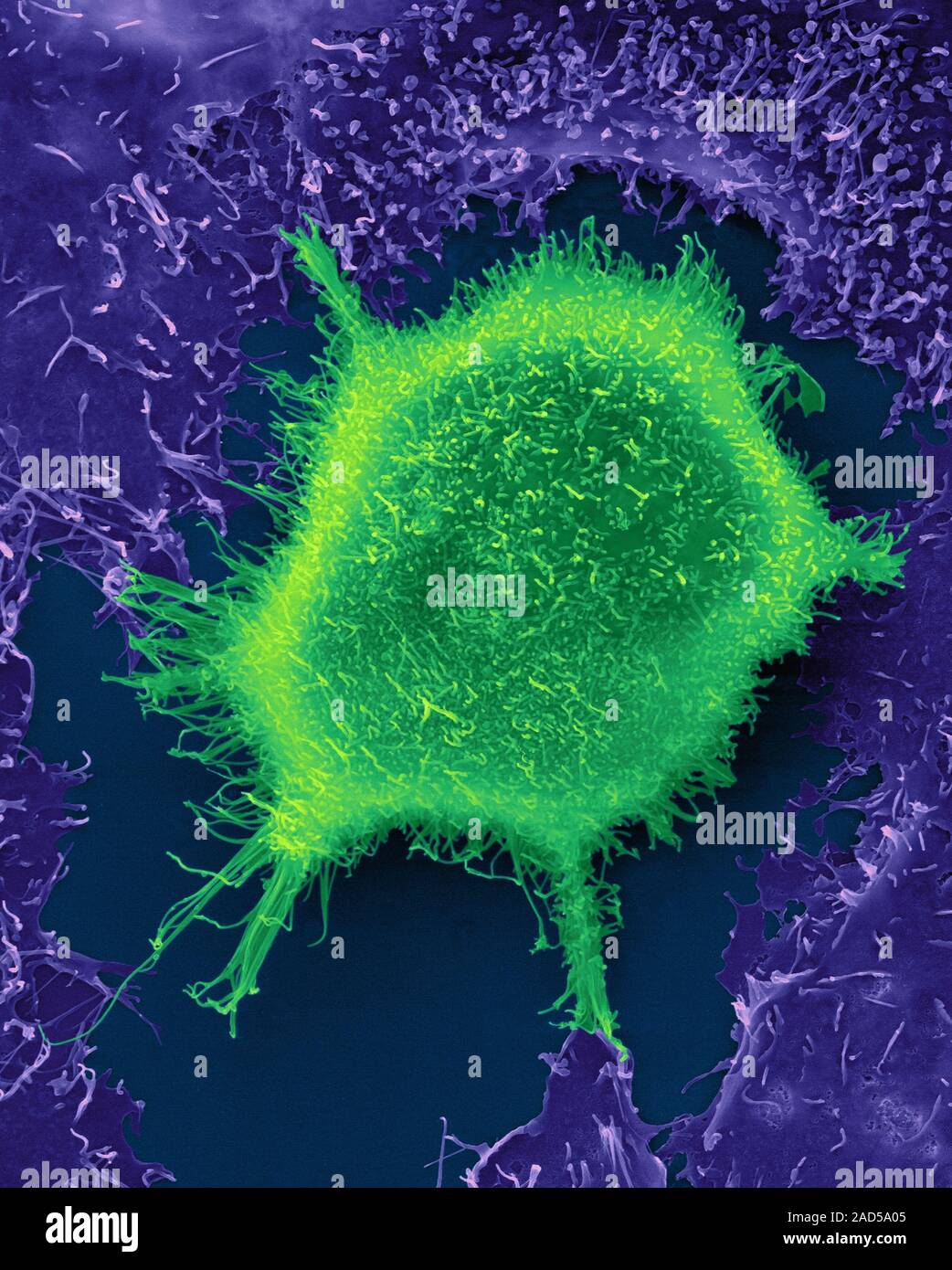 Human lung epithelial cancer cell among healthy epithelial cells ...