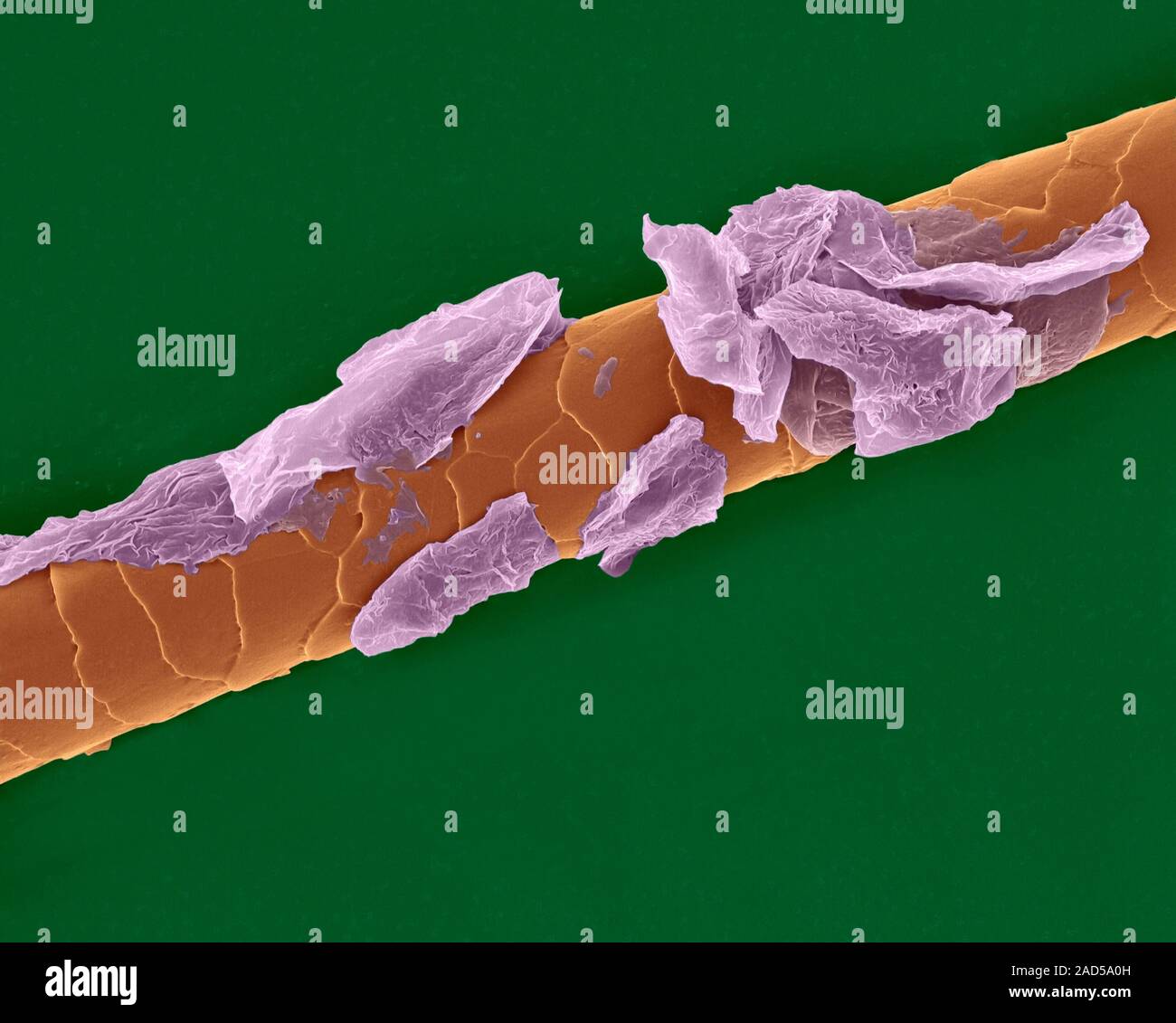 Human hair with dandruff, coloured scanning electron micrograph (SEM ...