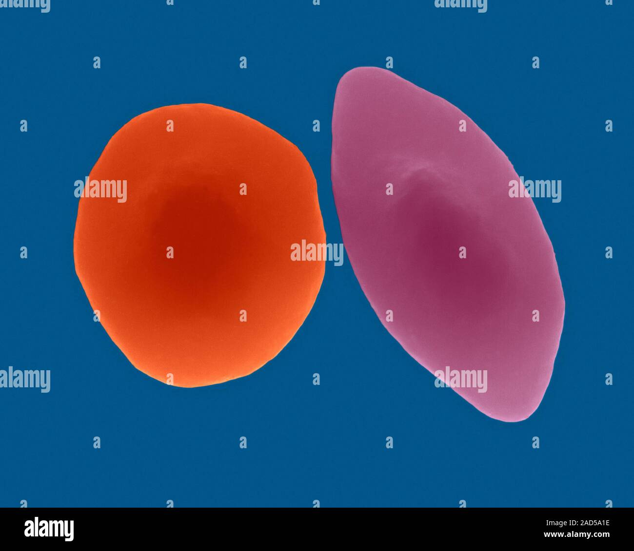 Sickle red blood cell (oblong, tapered cell) and healthy red blood cell ...