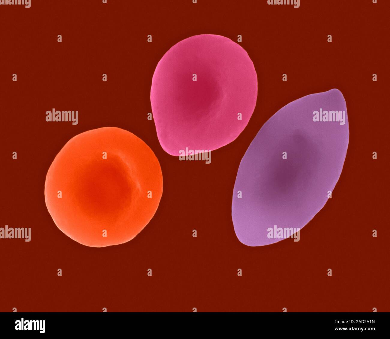 Healthy, intermediate and sickle human red blood cells (oblong, tapered ...