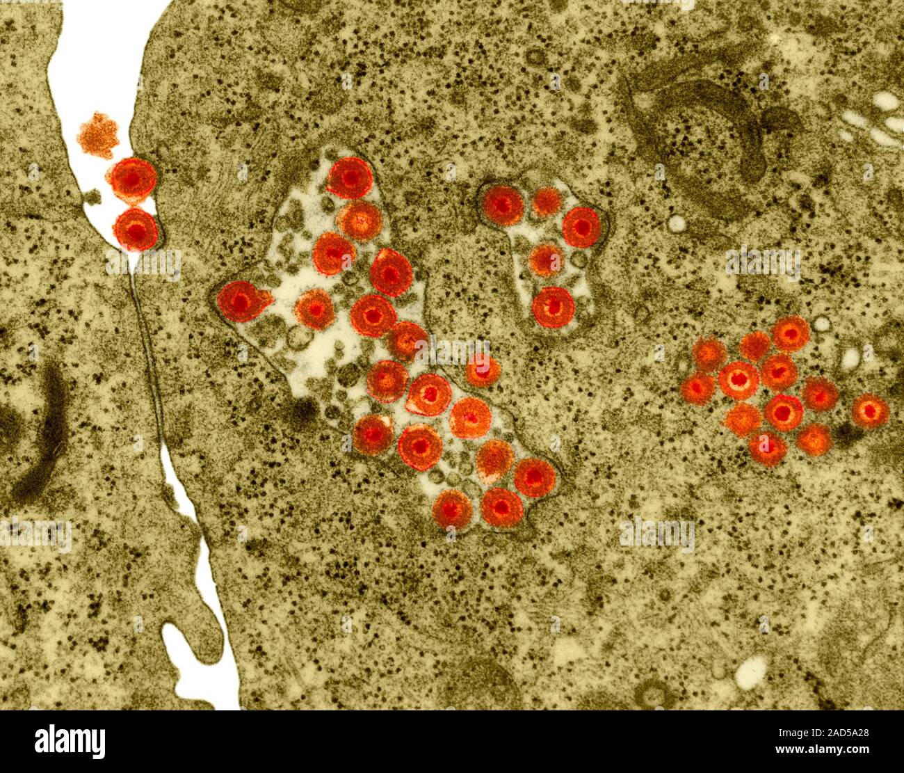 Herpes simplex virus (HSV-2, DNA virus) in cellular vacuoles and ... Herpes simplex virus (HSV-2, DNA virus) in cellular vacuoles and ...