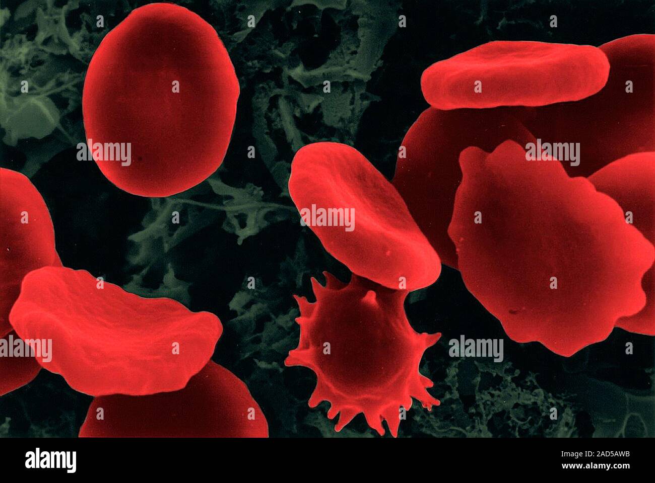Human red blood cells in hypertonic solution (1.01% NaCl), coloured ...