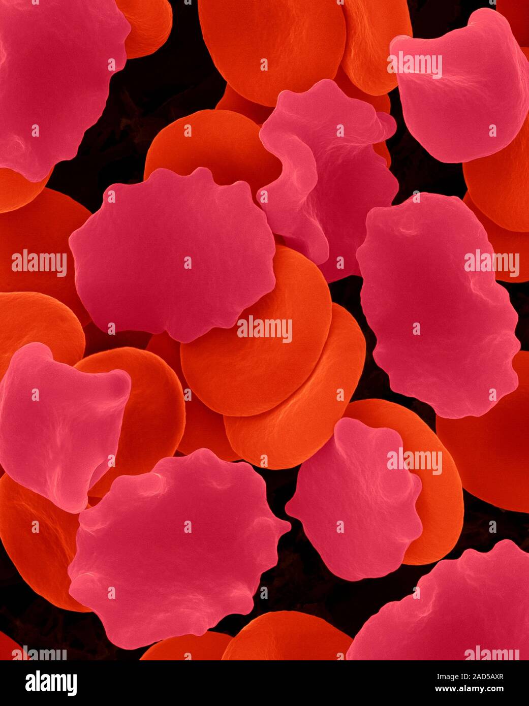 Human red blood cells in hypertonic solution (1.01% NaCl), coloured ...