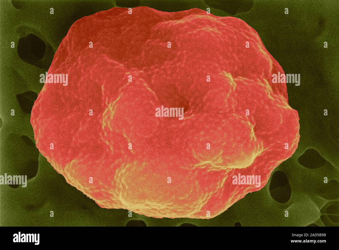 Red blood cell (erythrocyte) infected with malaria parasite (Plasmodium ...