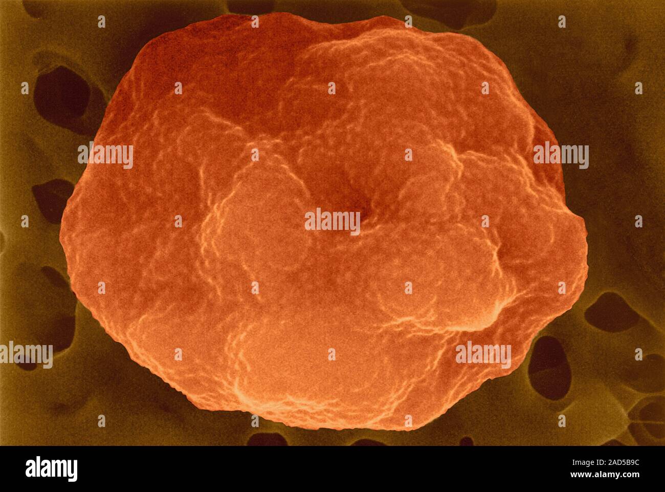 Red blood cell (erythrocyte) infected with malaria parasite (Plasmodium ...