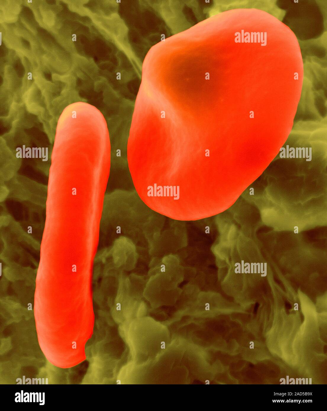 Normal red blood cell (erythrocyte) and red blood cell infected with ...