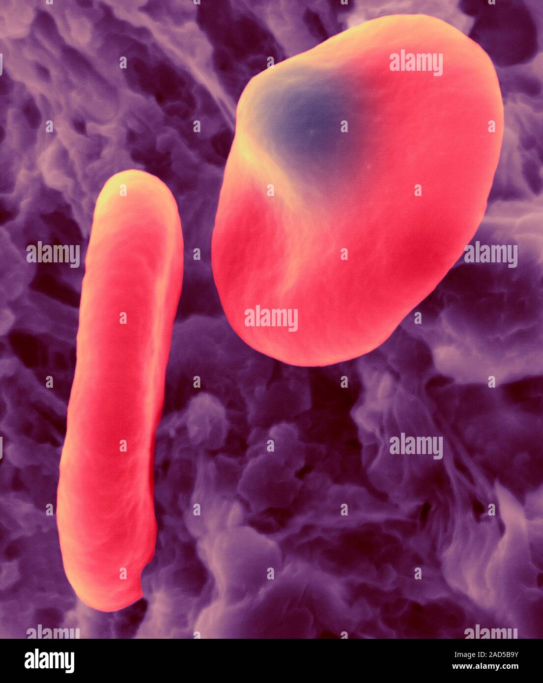 Normal red blood cell (erythrocyte) and red blood cell infected with ...