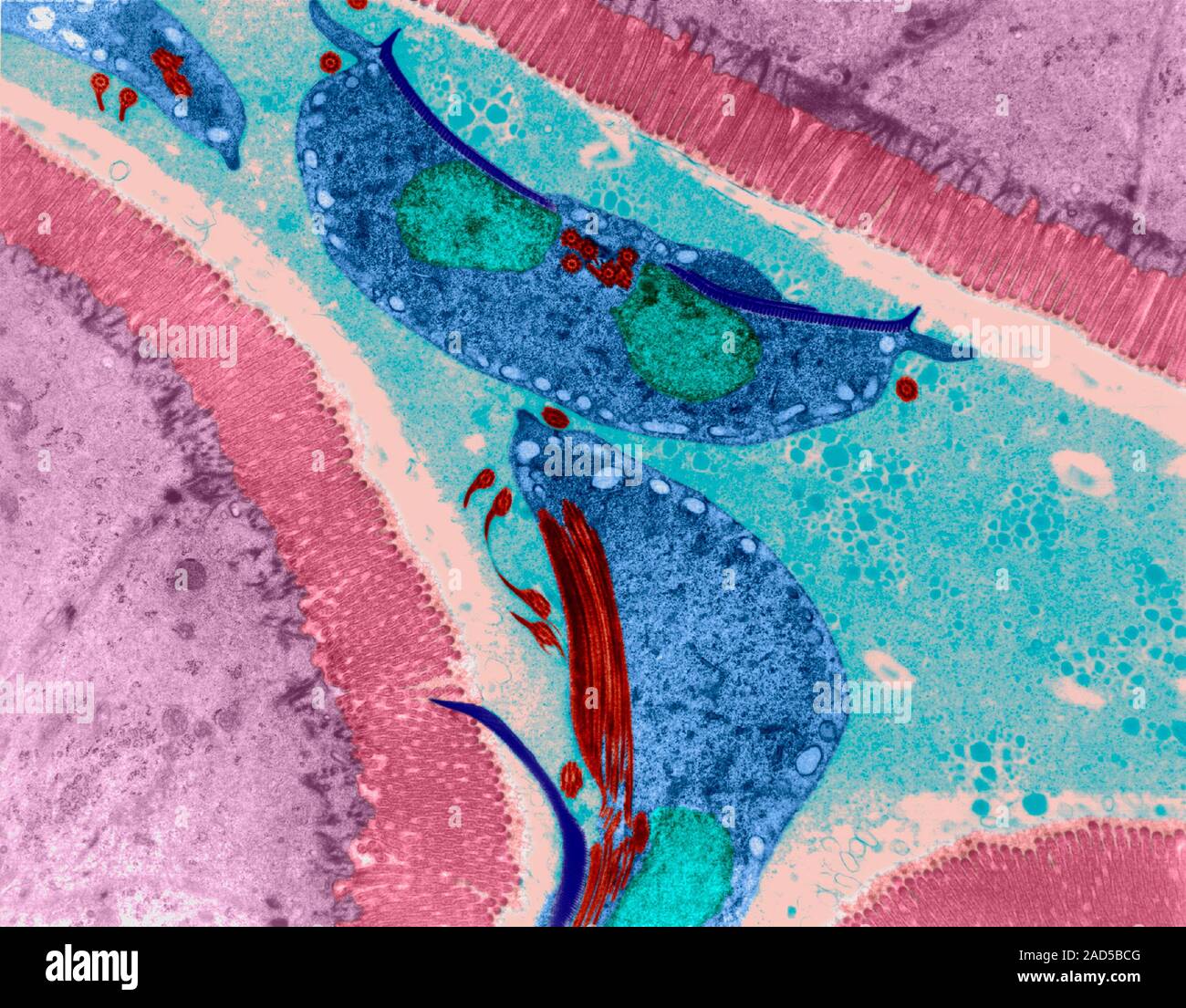 Protozoan infection (giardiasis) in human intestinal lumen (Giardia sp ...