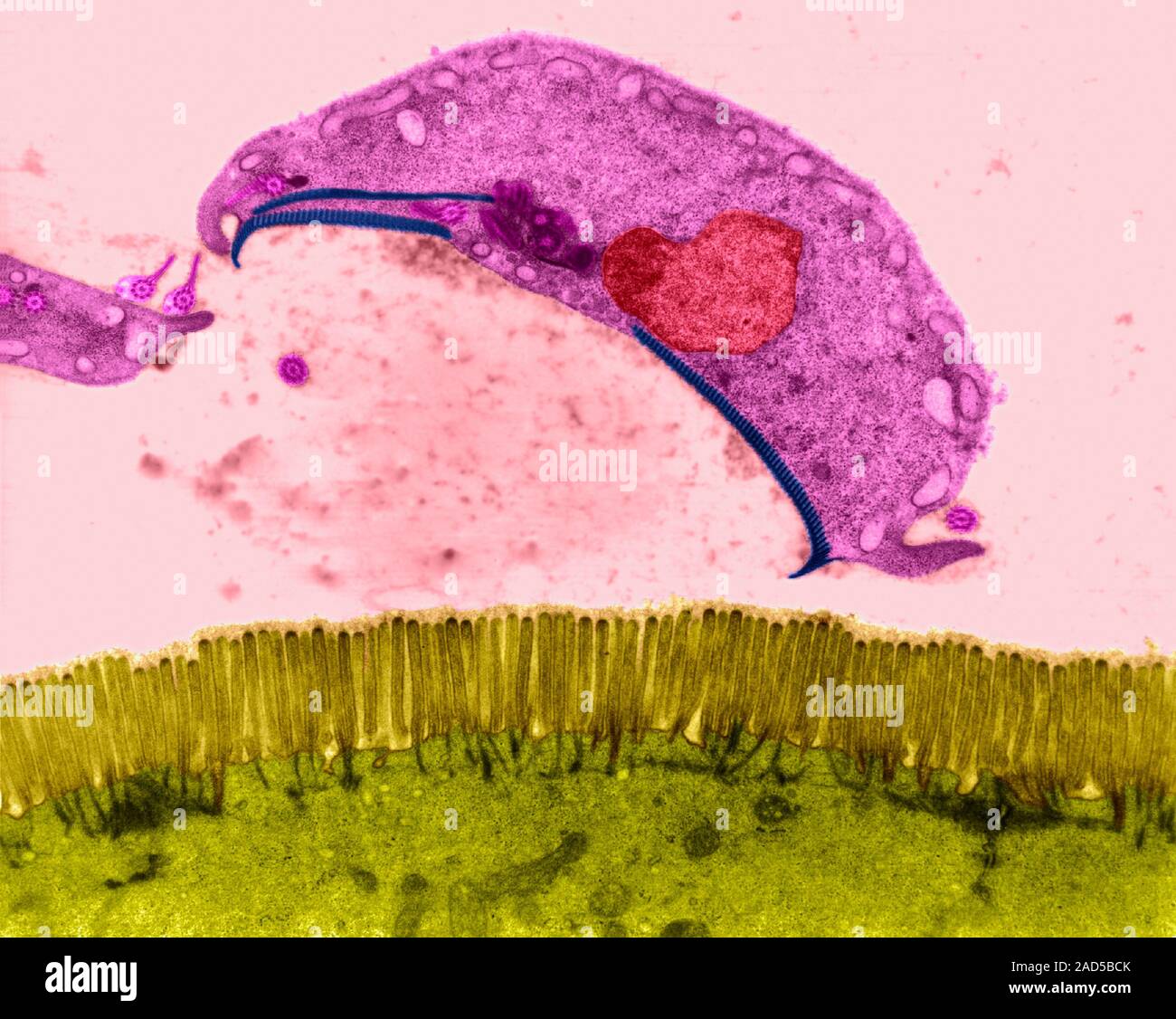 Protozoan infection (giardiasis) in human intestinal lumen (Giardia sp ...