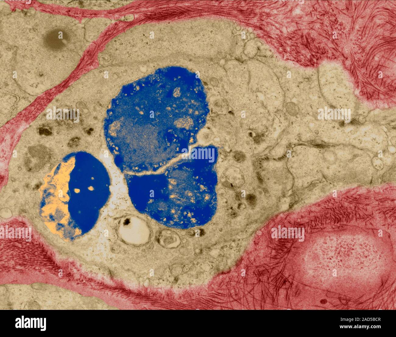 Cryptosporidium parvum, microsporidial infection (cryptosporidiosis) in ...