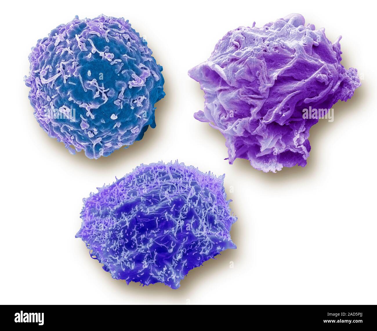 Chilhood cancers. Coloured scanning electron micrograph (SEM) of cells ...