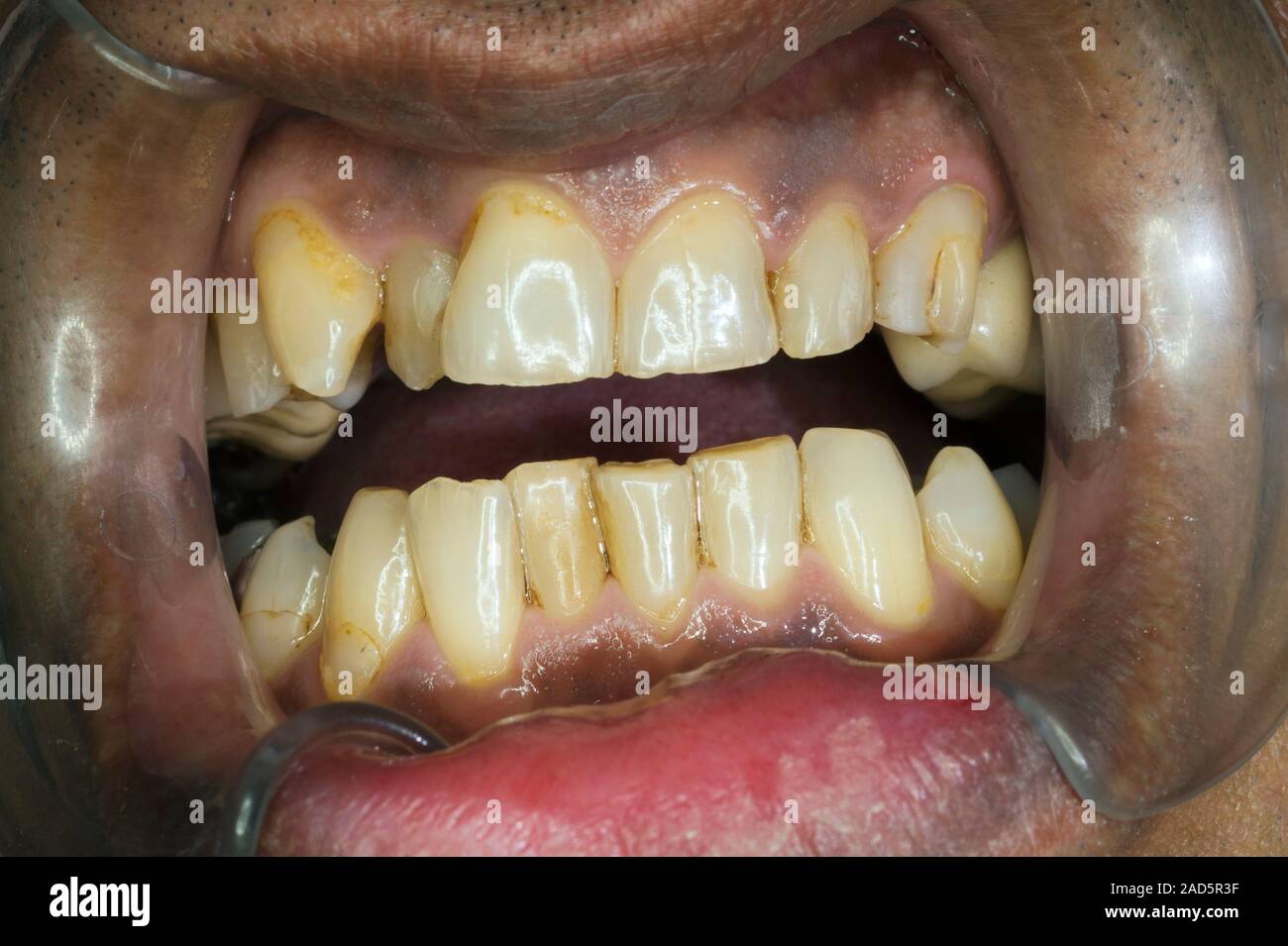 Teeth before whitening. Close-up of the mouth of a patient just prior ...