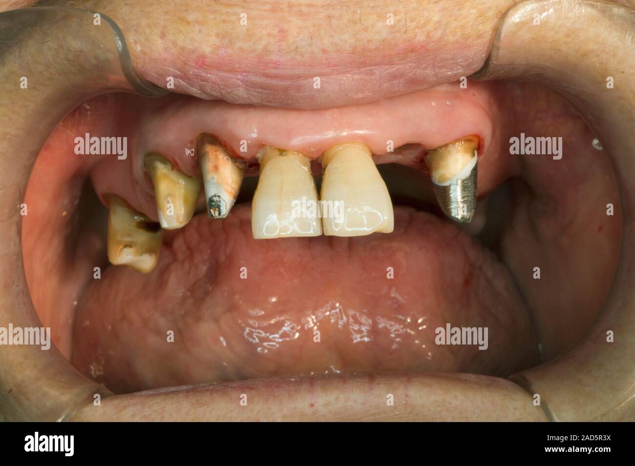Dental crown preparation. Close-up of the upper teeth of a 72-year-old ...