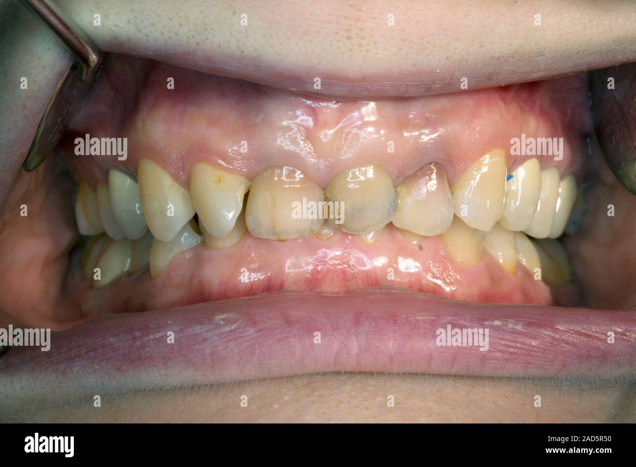 Dental Malocclusion A Malocclusion Is Misalignment Between The Teeth