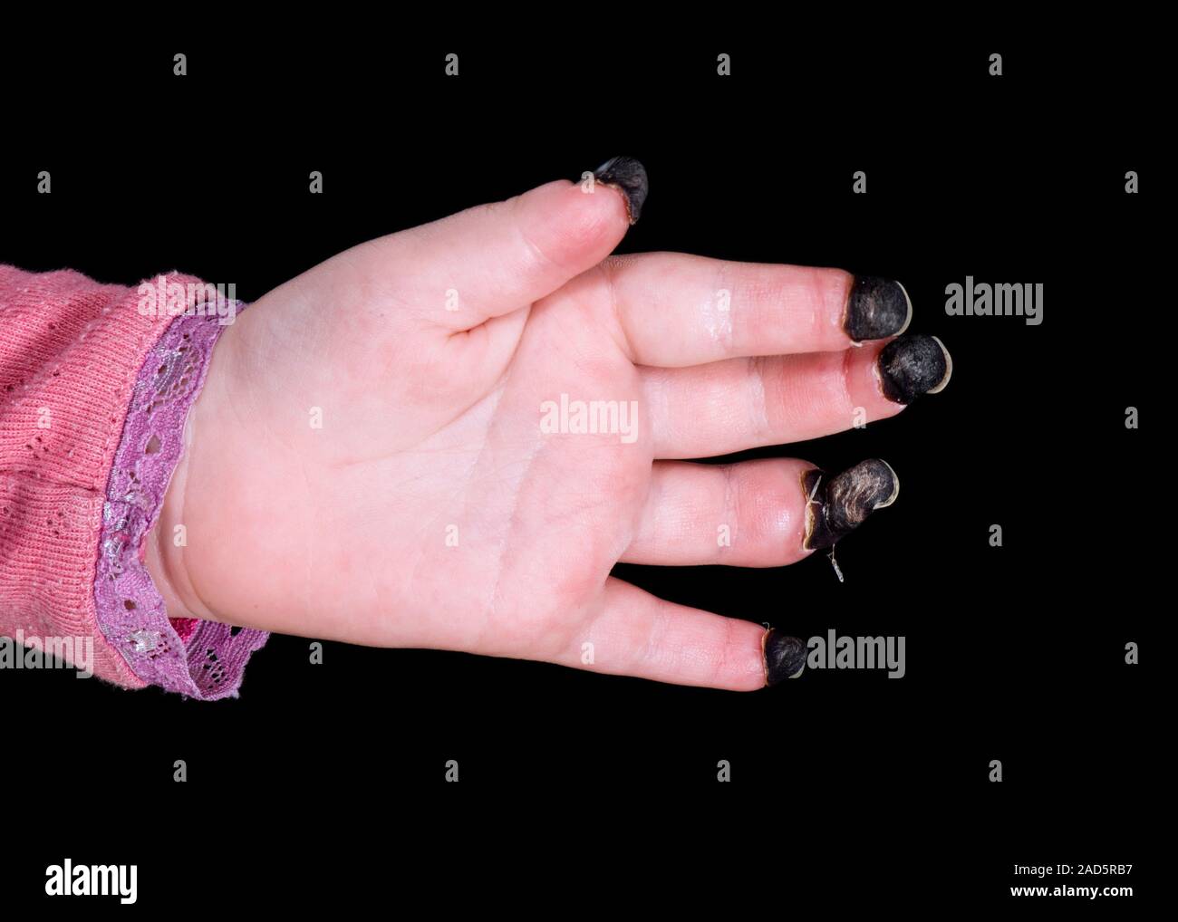 Gangrenous finger tips in the left hand of a 3-year-old girl ...