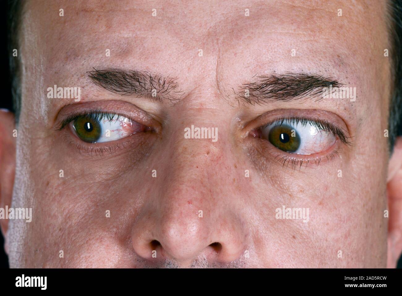 Positions of gaze, looking right. 50-year-old man demonstrating one of ...