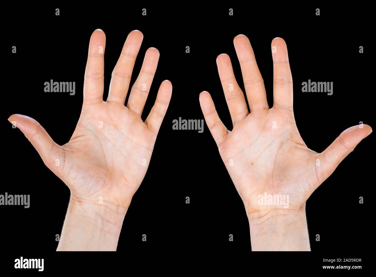 Eczema (patches) affecting the skin on the palms of a 25-year-old woman ...
