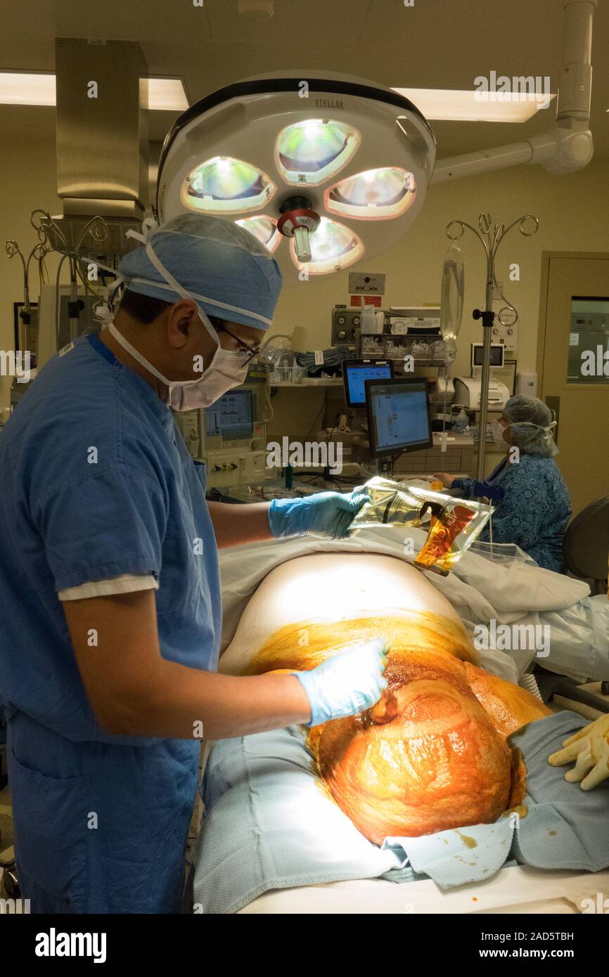 Scrotal hernia surgery. Surgeons disinfecting the enlarged scrotum of a ...