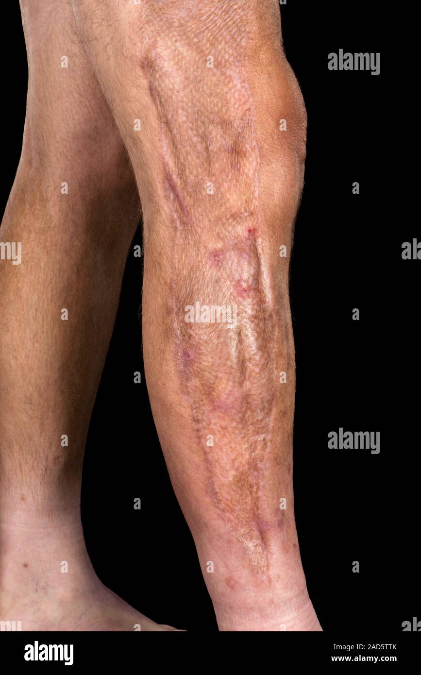 Healed leg after necrotizing fasciitis. Left leg of a 62-year-old man ...
