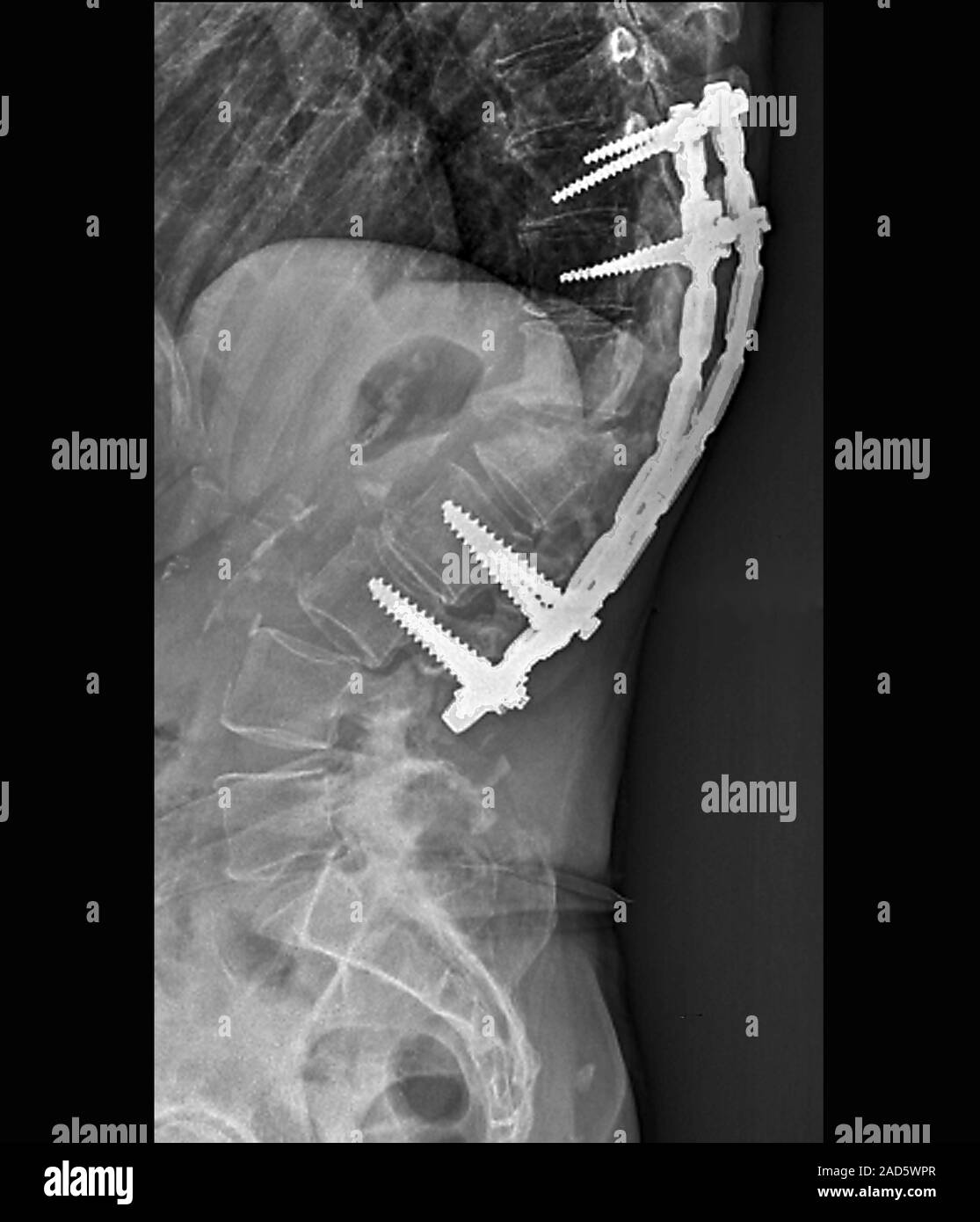 Spinal implant in kyphosis. Lateral X-ray of the spine of a 68-year-old ...