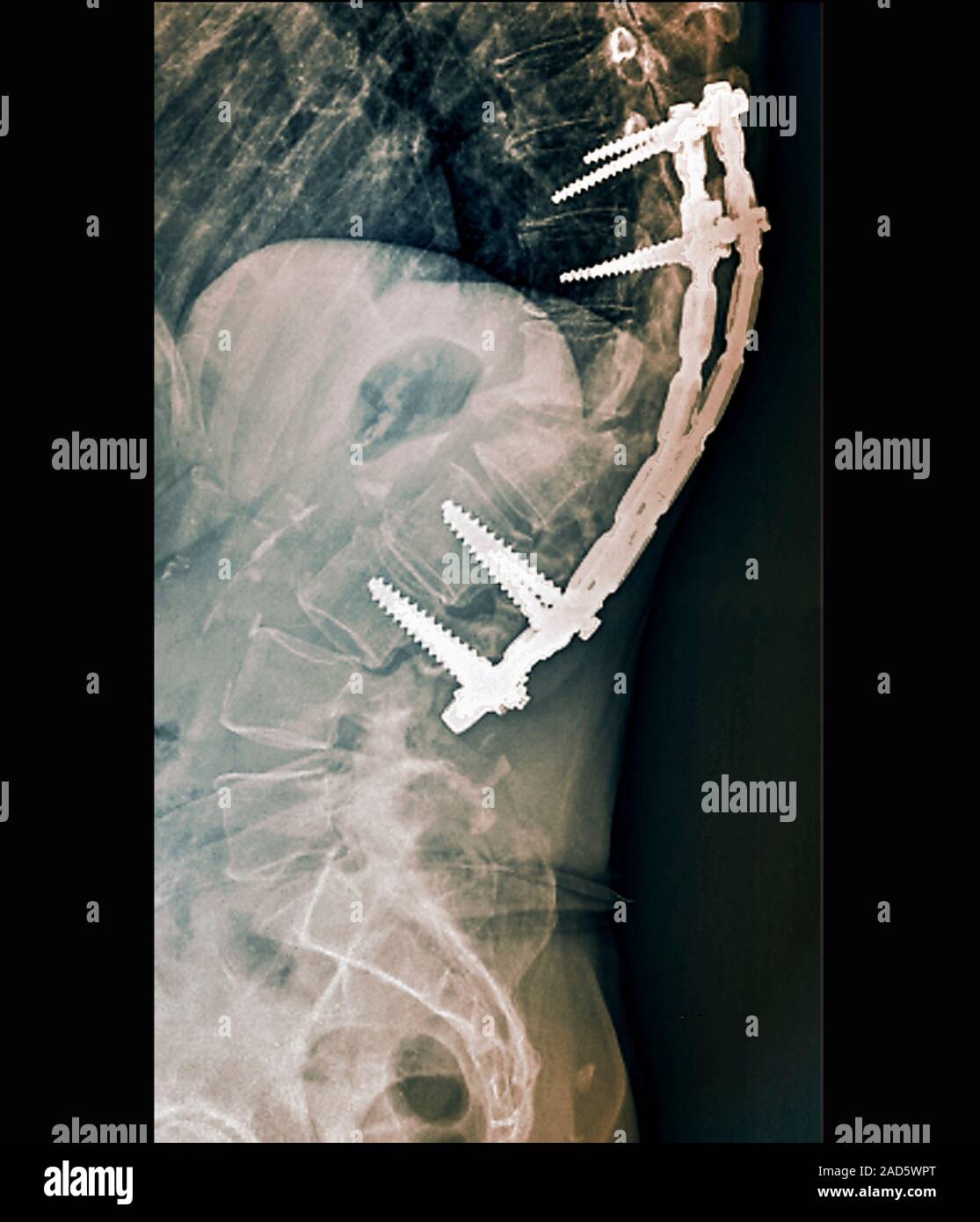 Spinal implant in kyphosis. Coloured lateral X-ray of the spine of a 68 ...