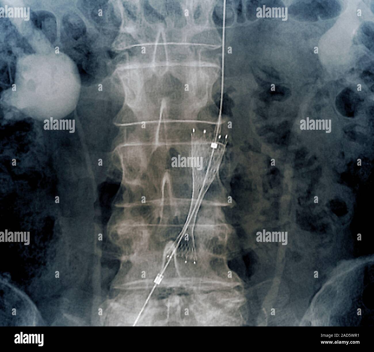 Implantation of stent in aorta. Coloured frontal X-ray of a stent (mesh ...