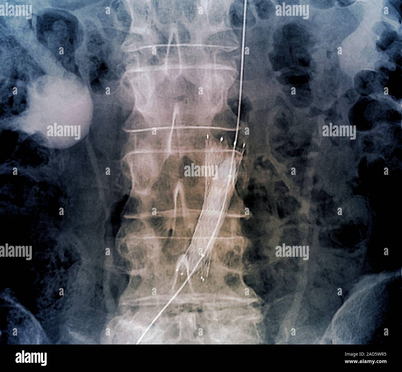 Expansion of stent in aorta. Coloured frontal X-ray of a stent (mesh at ...