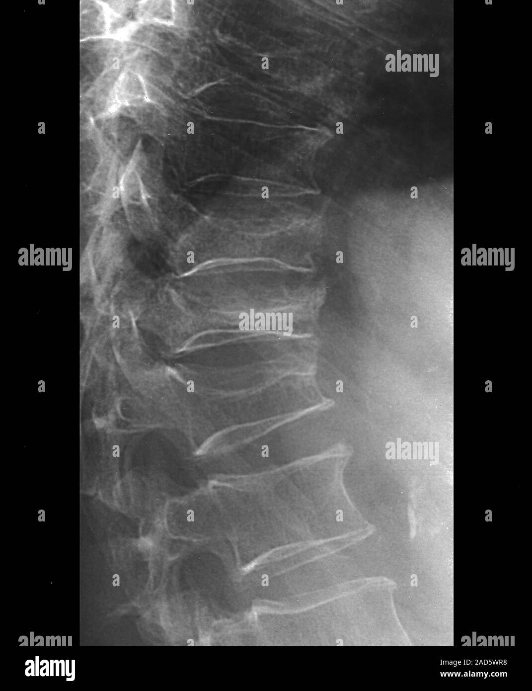 Osteoporotic spine. Lateral X-ray of the vertebral column at the ...
