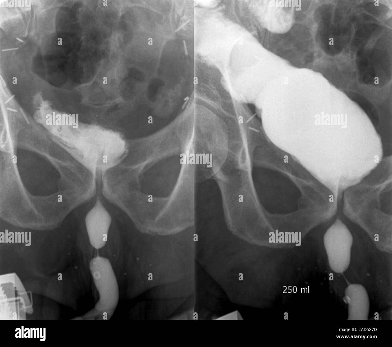 Augmented bladder. Retrograde cystography image (bladder X-ray) using a ...