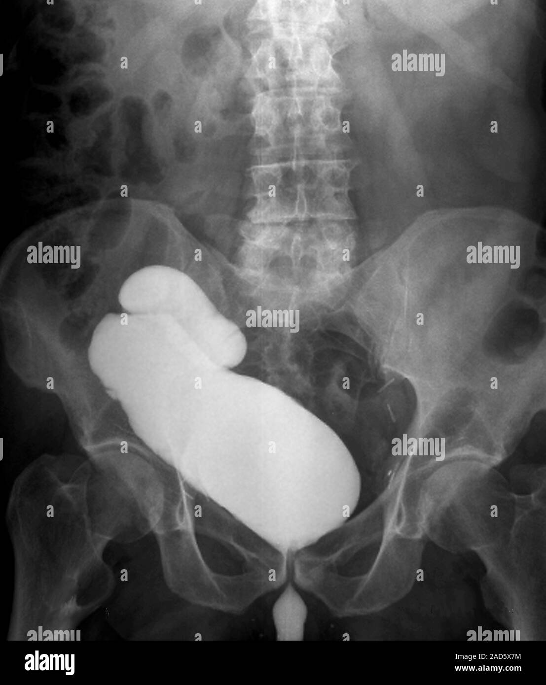 Augmented bladder. Retrograde cystography image (bladder X-ray) using a ...