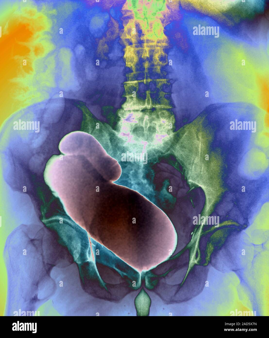 Augmented bladder. Coloured retrograde cystography image (bladder X-ray ...
