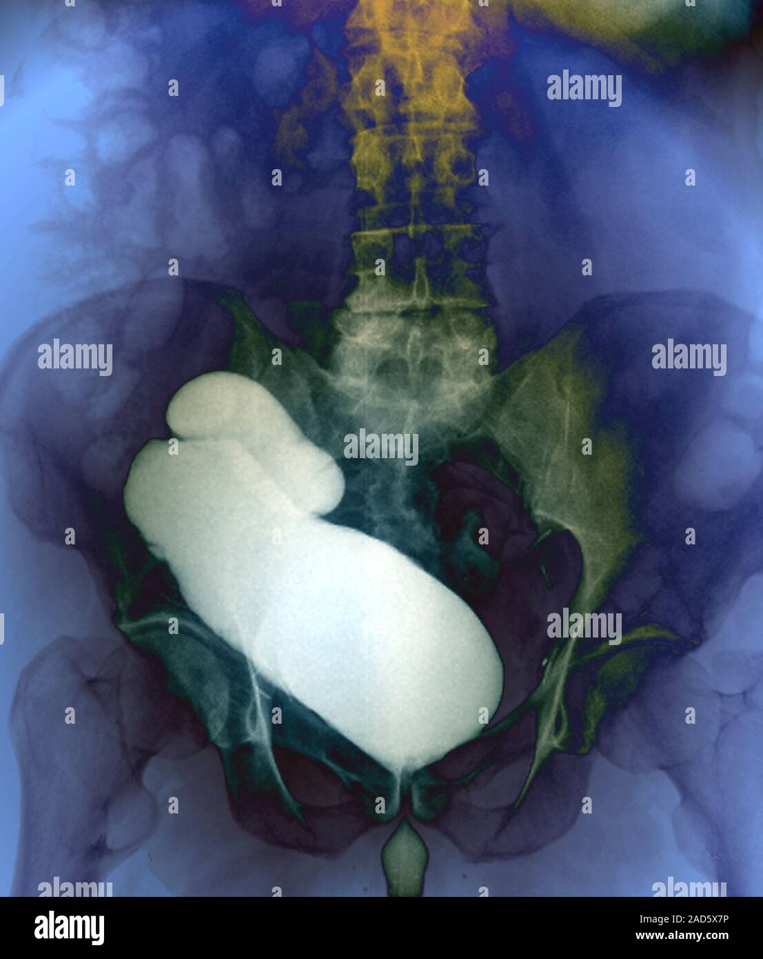 Augmented bladder. Coloured retrograde cystography image (bladder X-ray ...