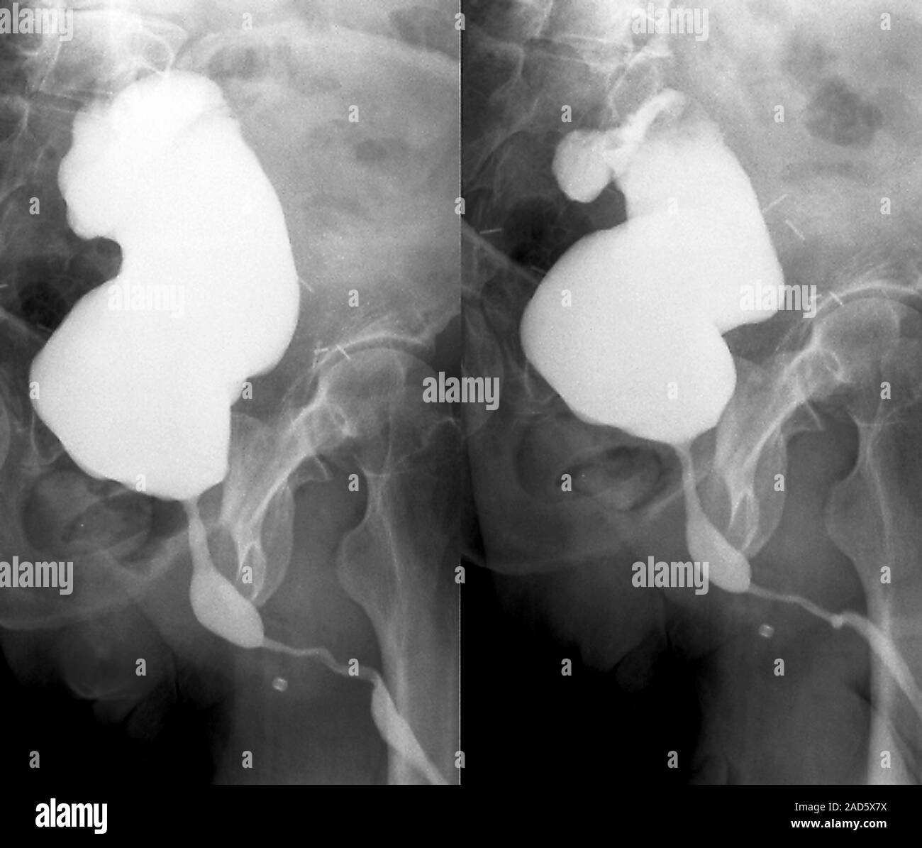 Augmented bladder. Retrograde cystography images (bladder X-ray) using ...