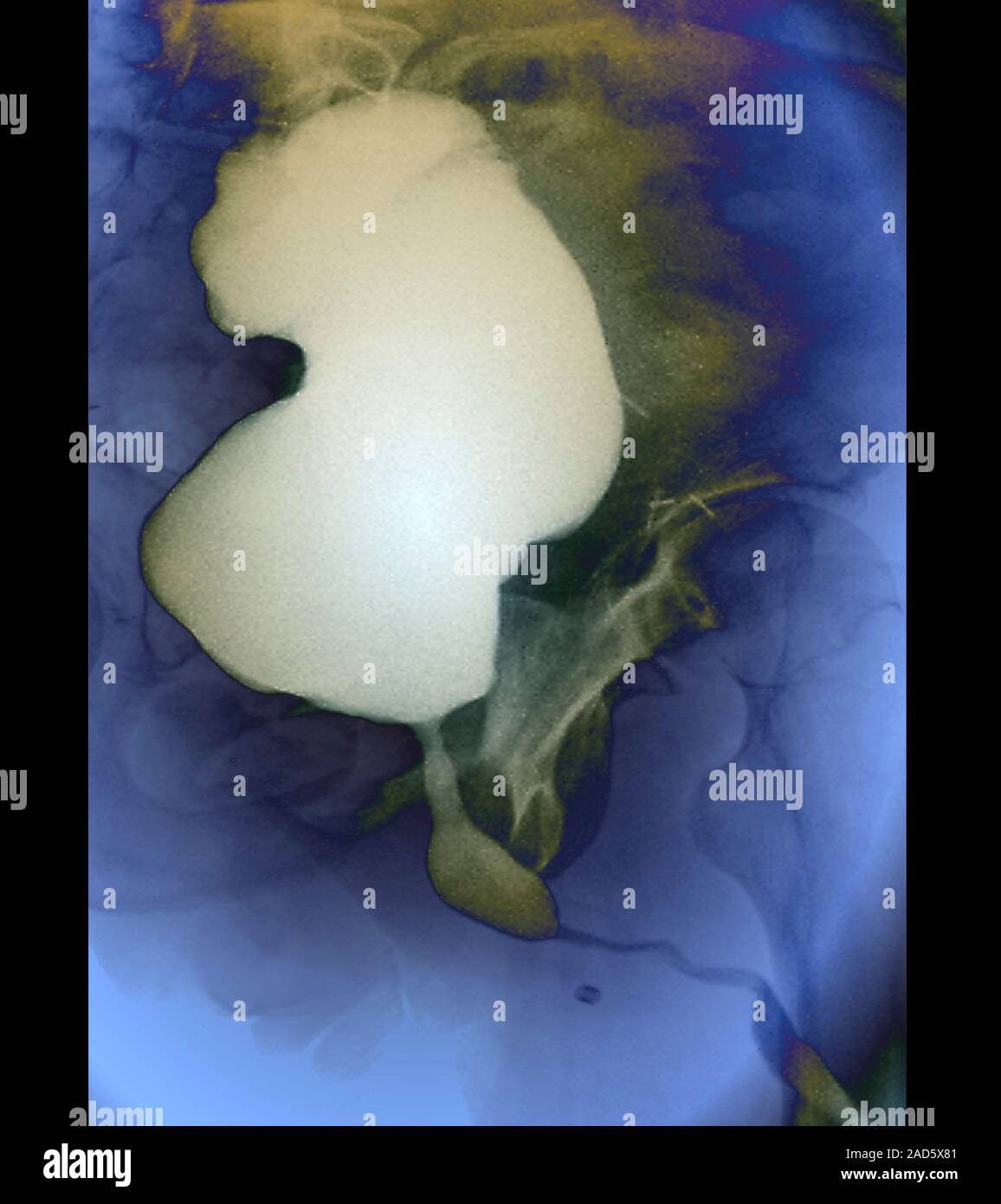 Augmented bladder. Coloured retrograde cystography image (bladder X-ray ...
