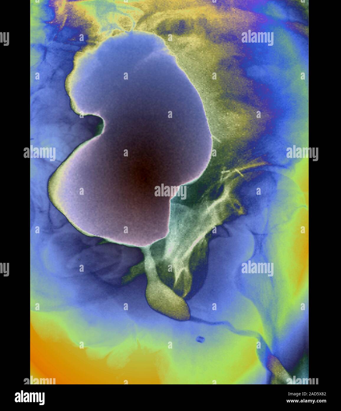 Augmented bladder. Coloured retrograde cystography image (bladder X-ray ...