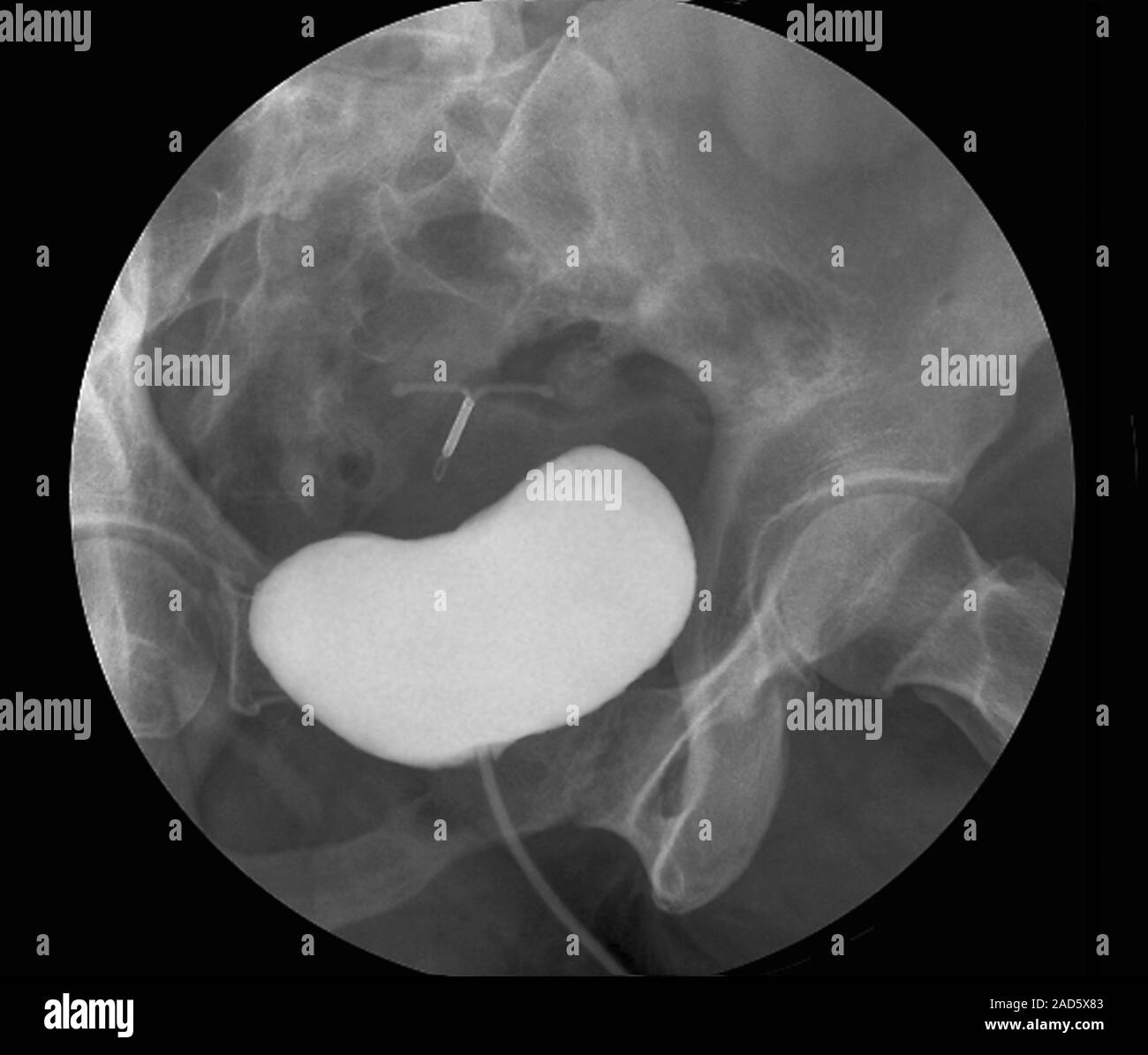 Weak bladder. Retrograde cystography image (bladder X-ray) using a ...