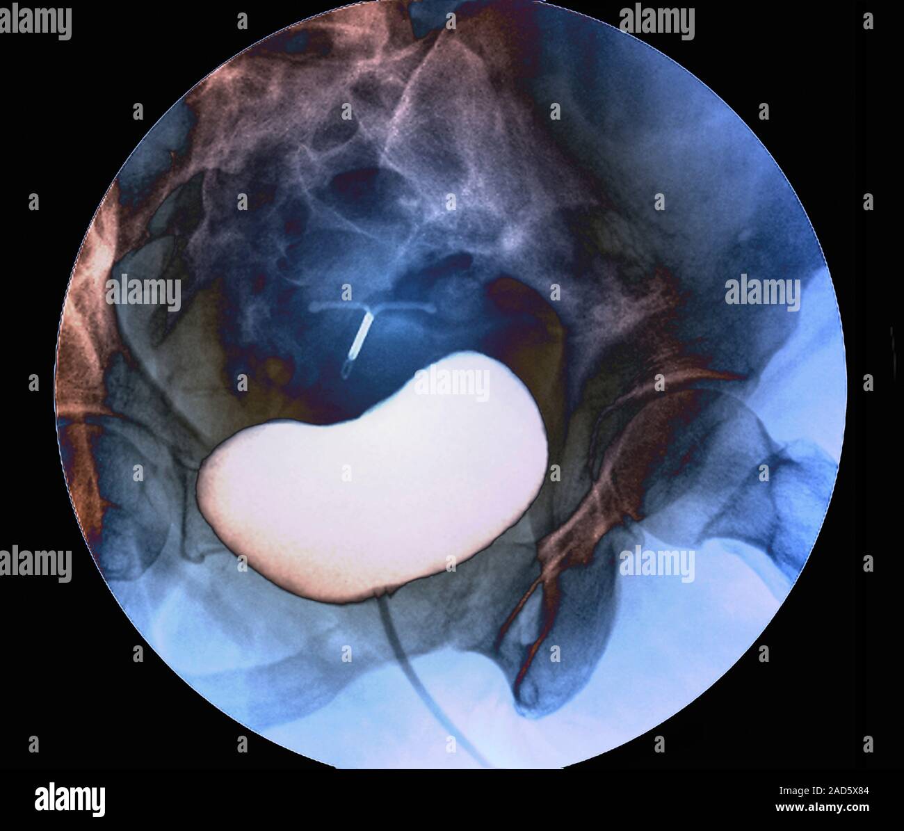Weak bladder. Coloured retrograde cystography image (bladder X-ray ...