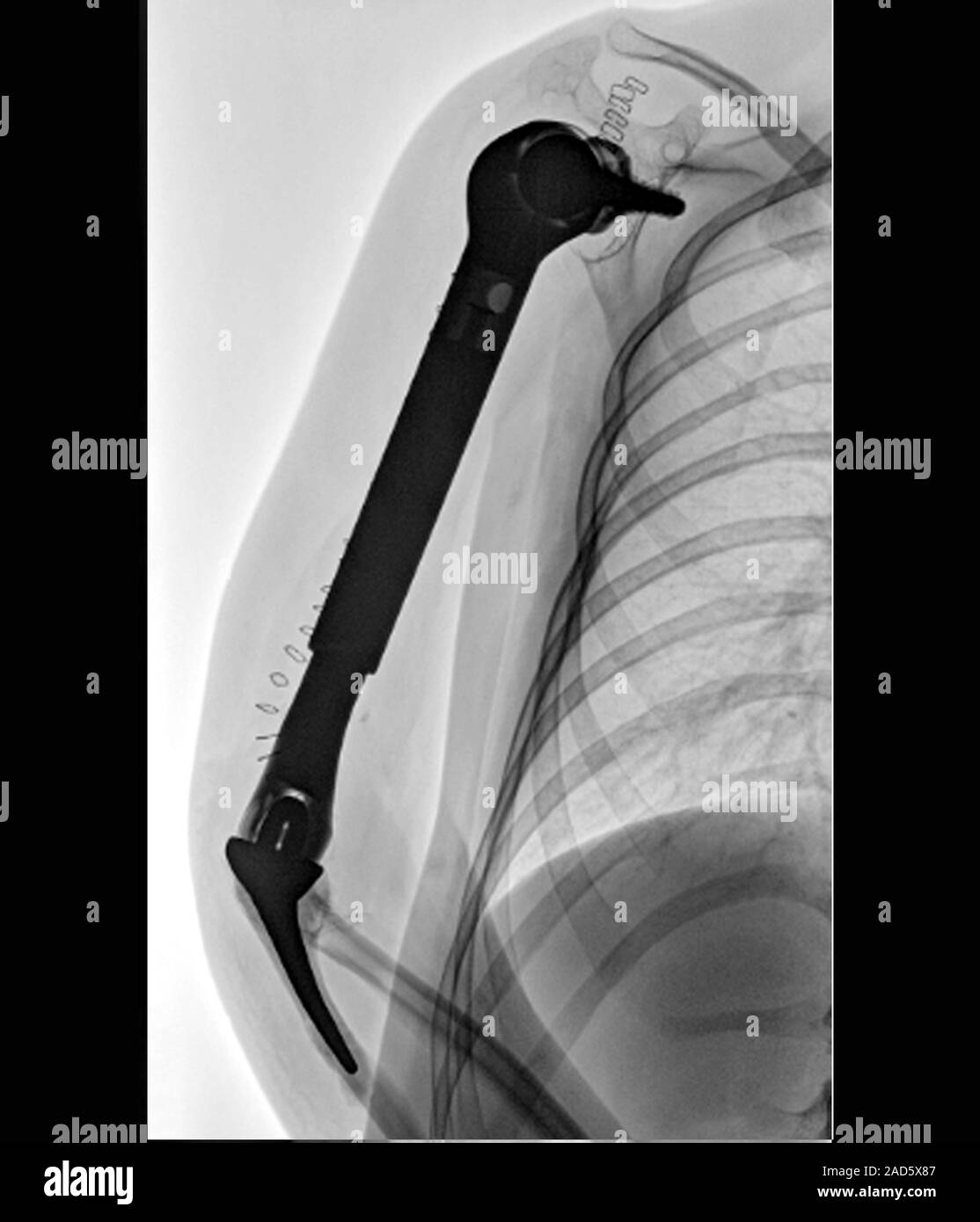 Prosthetic upper arm bone. X-ray of an upper arm bone (humerus) and ...