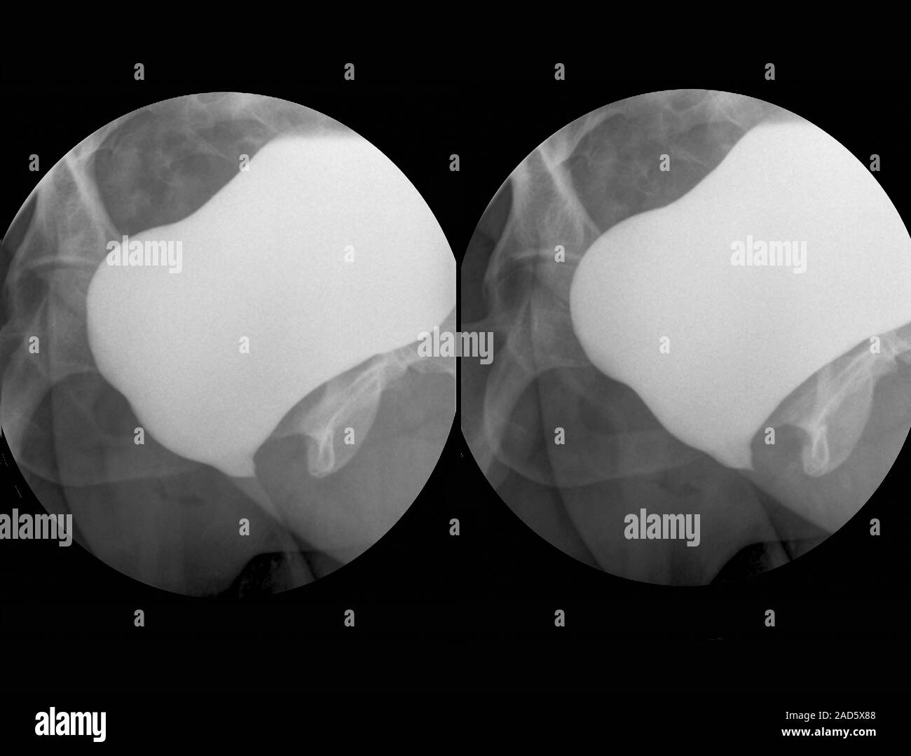 Urodynamic bladder test. Retrograde cystography images (bladder X-ray ...