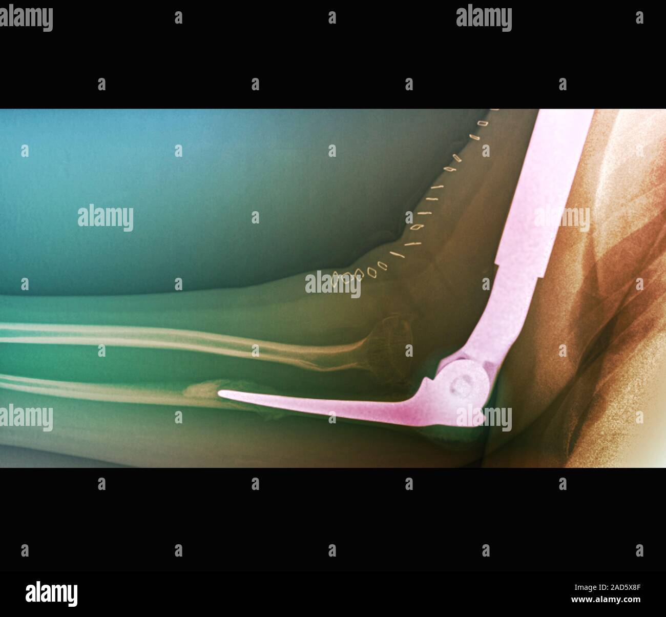 Elbow for prosthetic upper arm bone. Coloured X-ray of the artificial ...