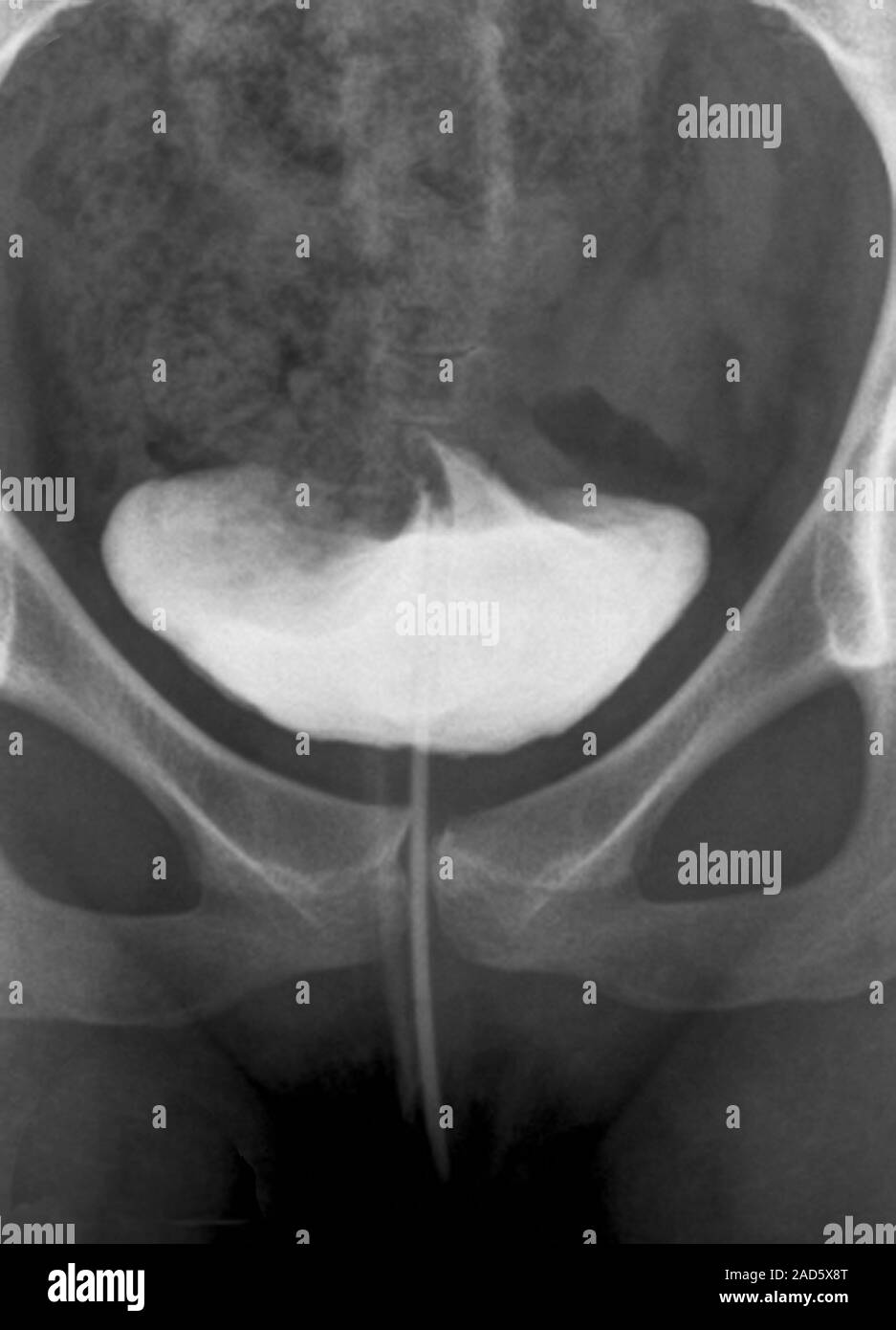 Urinary bladder examination. Retrograde and urinary urethrocystography ...